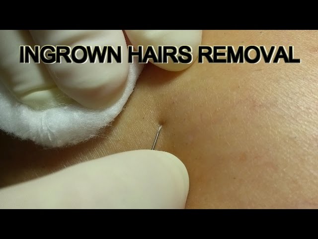 Encapsulated Ingrown Hair