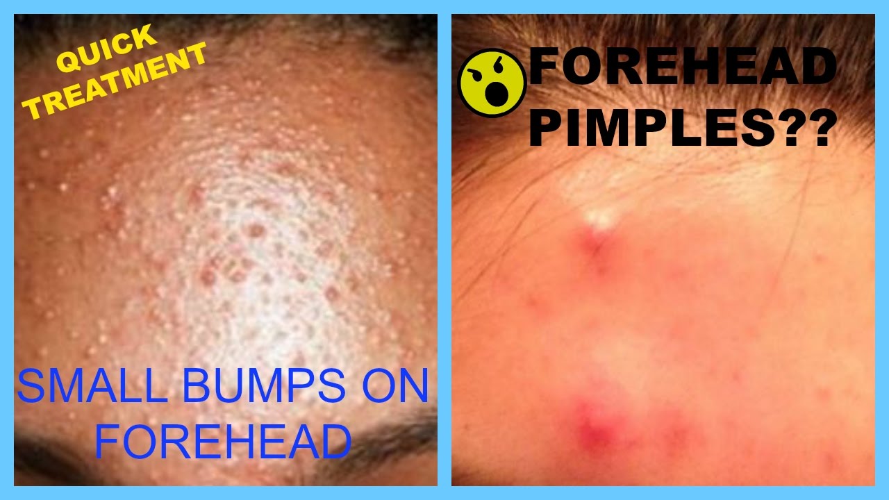 How To Stop Deep Pimples From Forming At Esther Corbett Blog