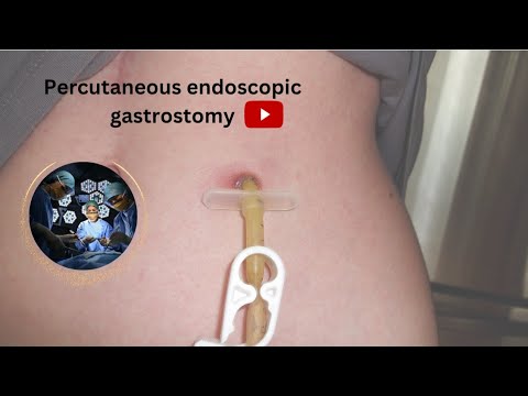 Peg Tube Percutaneous Endoscopic Gastrostomy Tube Youtube