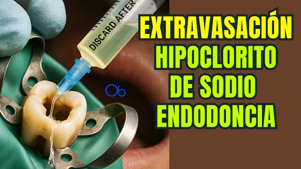 Extravasaciцёn De Hipoclorito De Sodio En Endodoncia п ії Caso Clцґnico