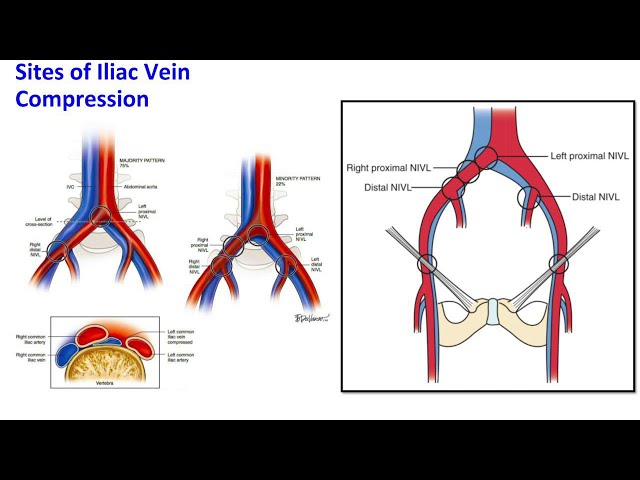 Common Iliac Vein Hemodynamic And Radiological Classification Of
