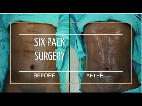 Six Pack Surgery Achieve A Sculpted Abdomen With Abdominal Etching