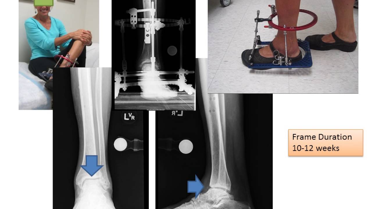 Ankle Distraction Surgery Youtube