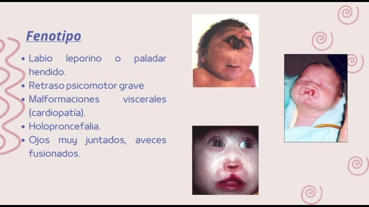 Sindrome De Patau Patau Syndrome Trisomy 13 Archives