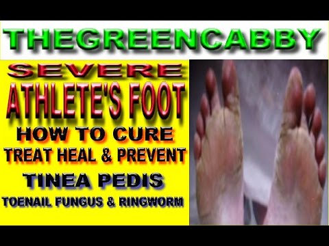 Severe Athlete S Foot How To Cure Athletes Foot Treat Heal Prevent