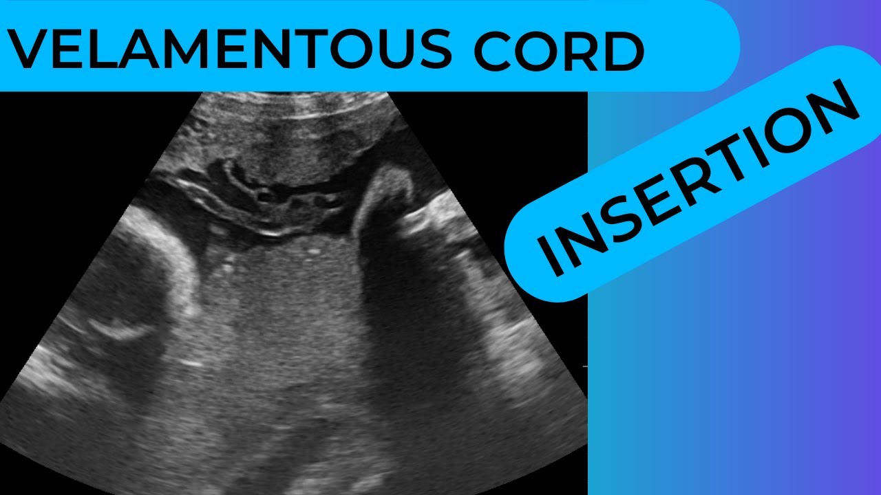 Velamentous Cord Insertion Ultrasound