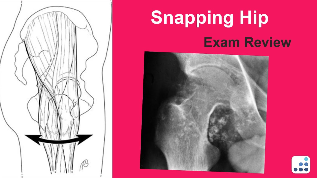 Snapping Hip Exam Review John Clohisy Md Youtube