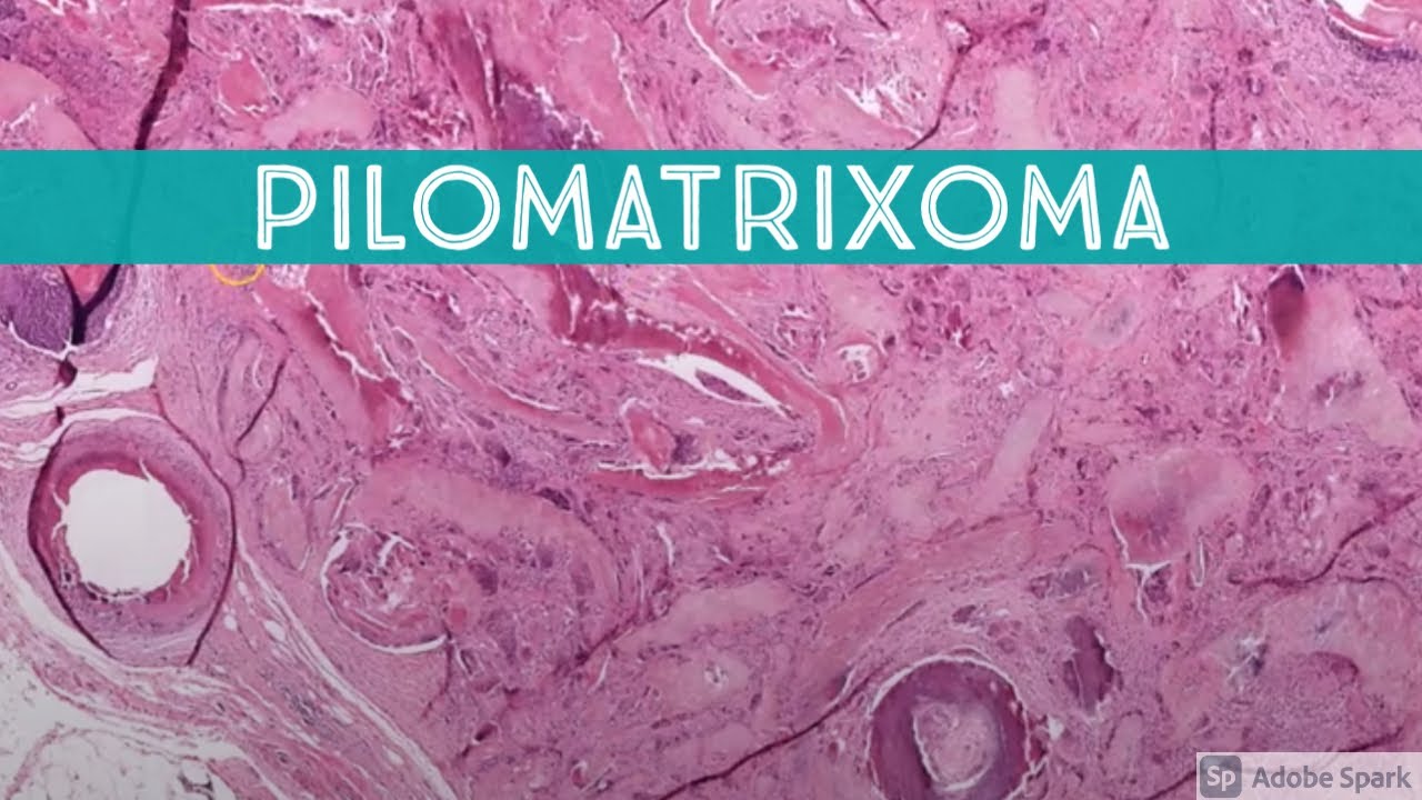 Pilomatricoma 5 Minute Pathology Pearls Youtube