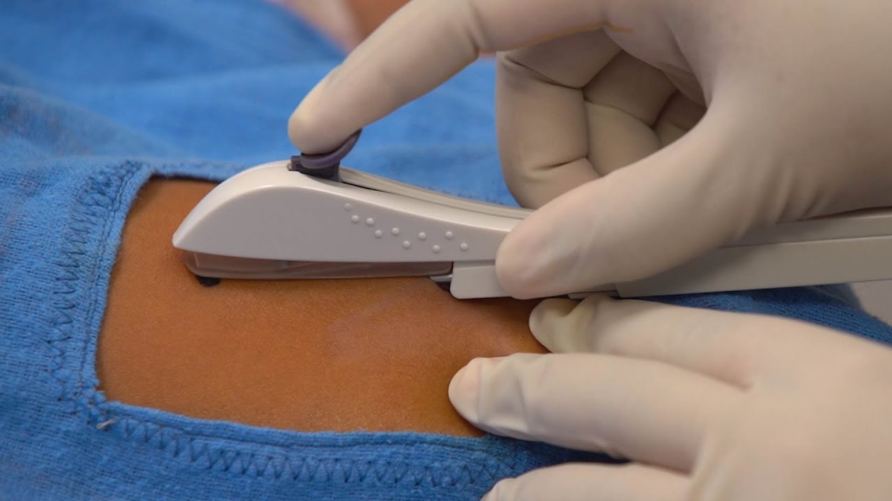Inserting A One Rod Implant Teaching Short Health Workers English