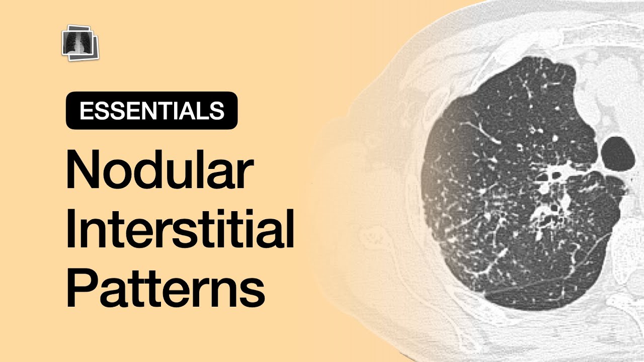 Nodular Interstitial Patterns Chest Radiology Essentials Youtube