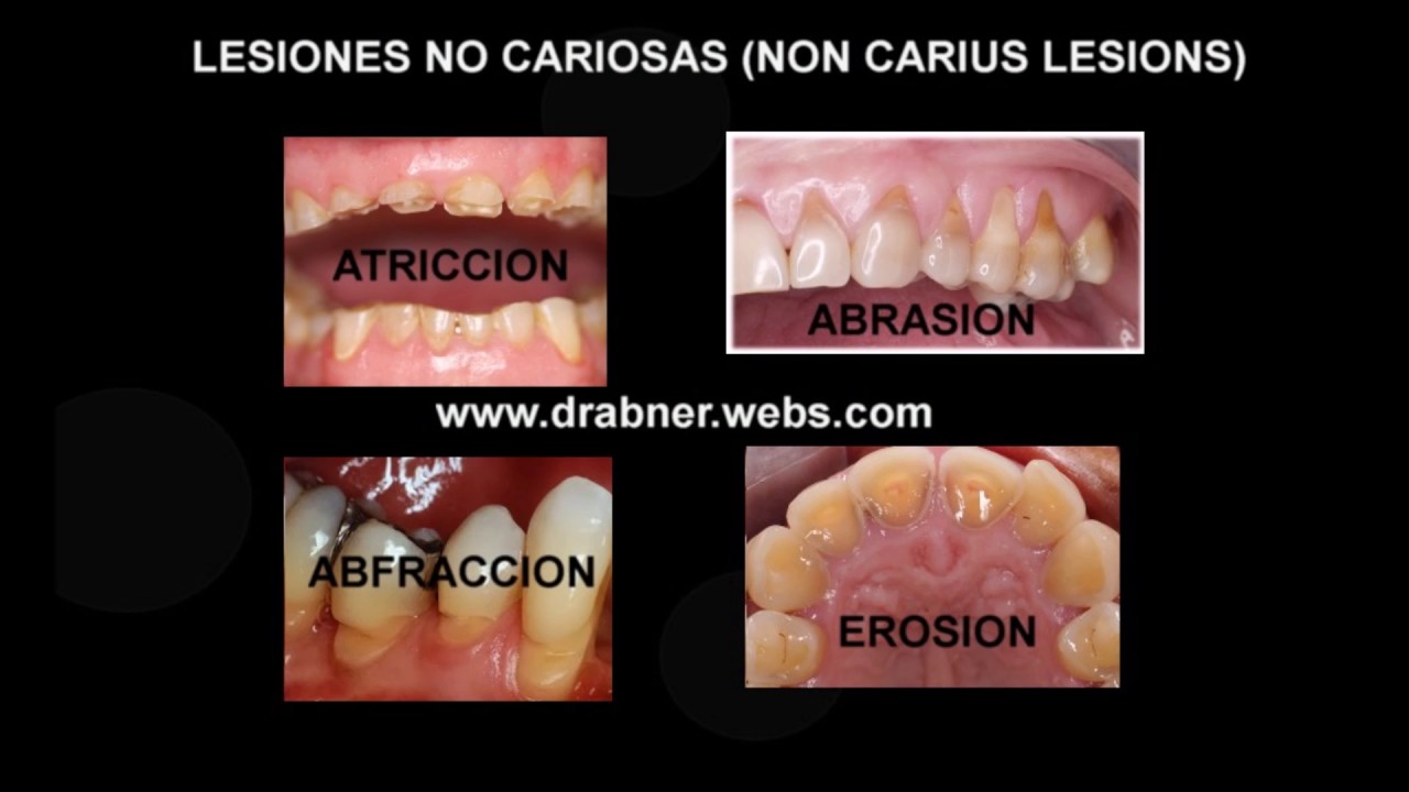 Lesiones No Cariosas Youtube