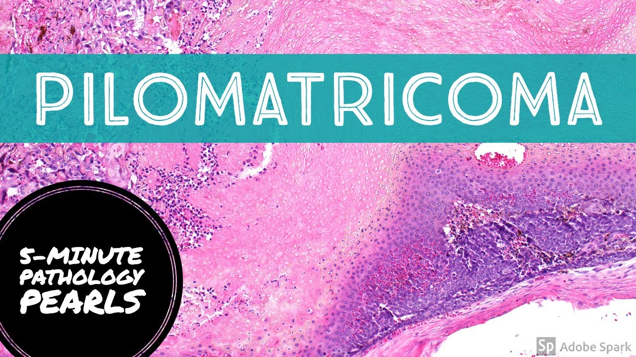 Pilomatricoma 5 Minute Pathology Pearls Youtube
