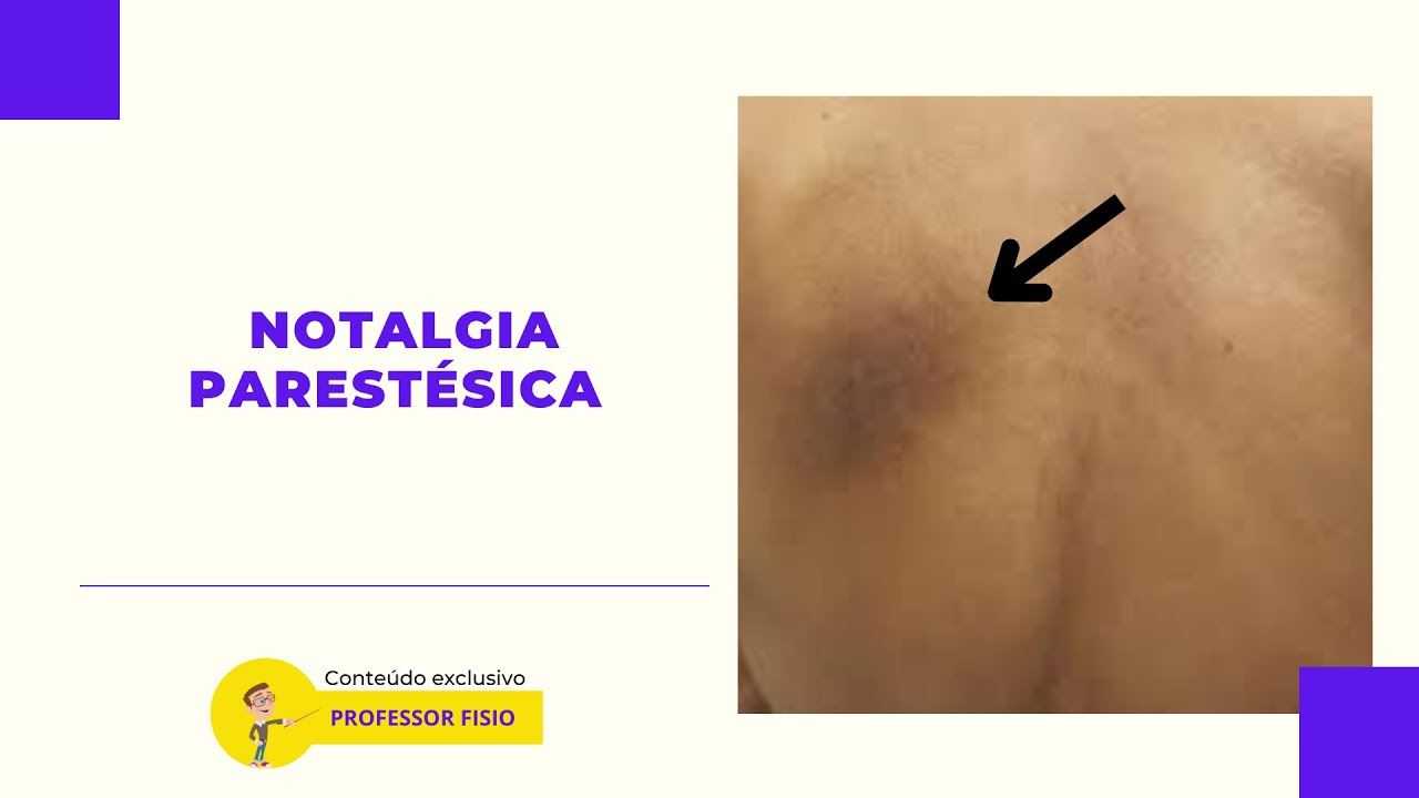 Notalgia Parestésica Tem Cura Retoedu