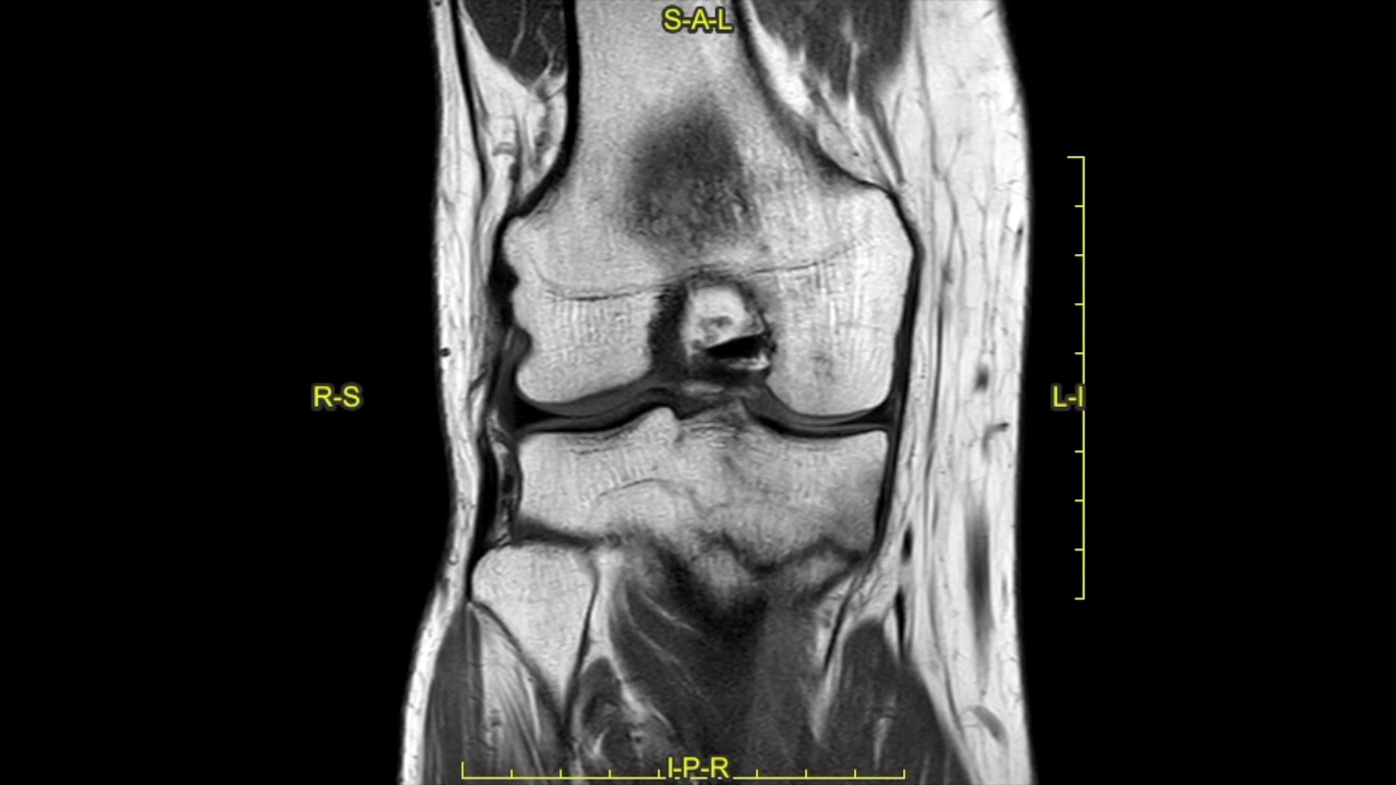 Tibial Stress Fracture Mri