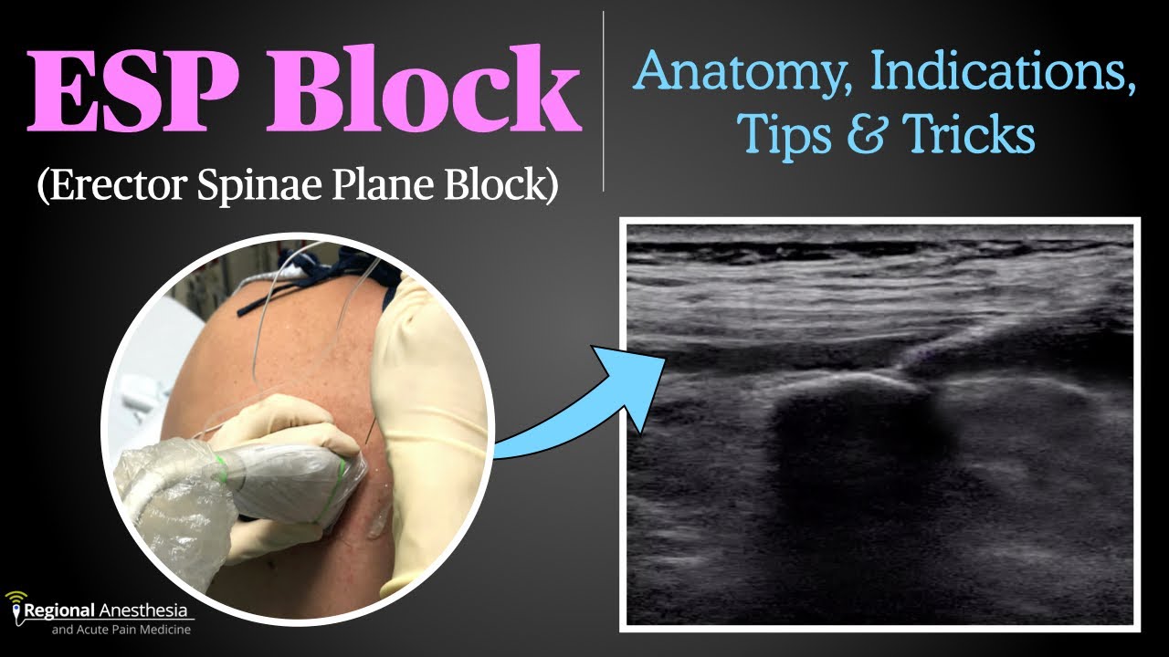 Erector Spinae Plane Esp Block Youtube