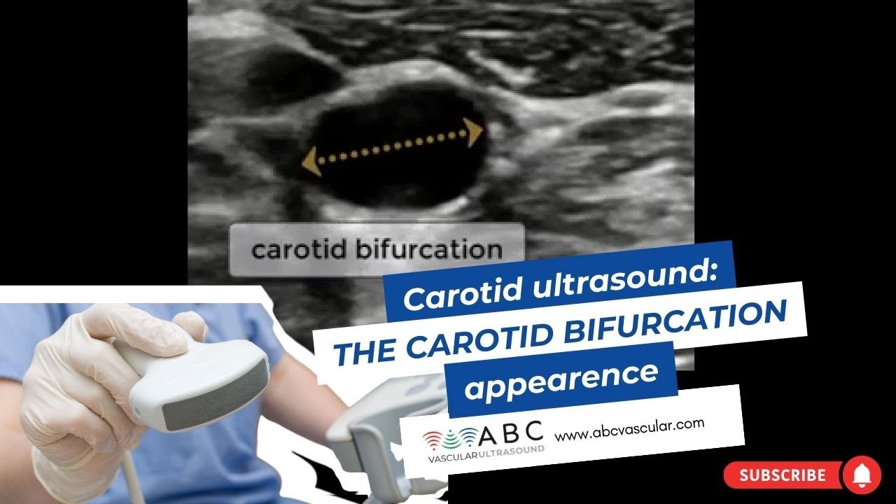 Usg Carotid Doppler Herysingles