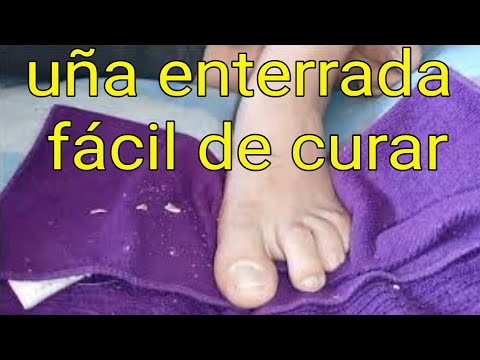 Como Curar Una Uña Del Pie Enterrada Muy Facil Youtube