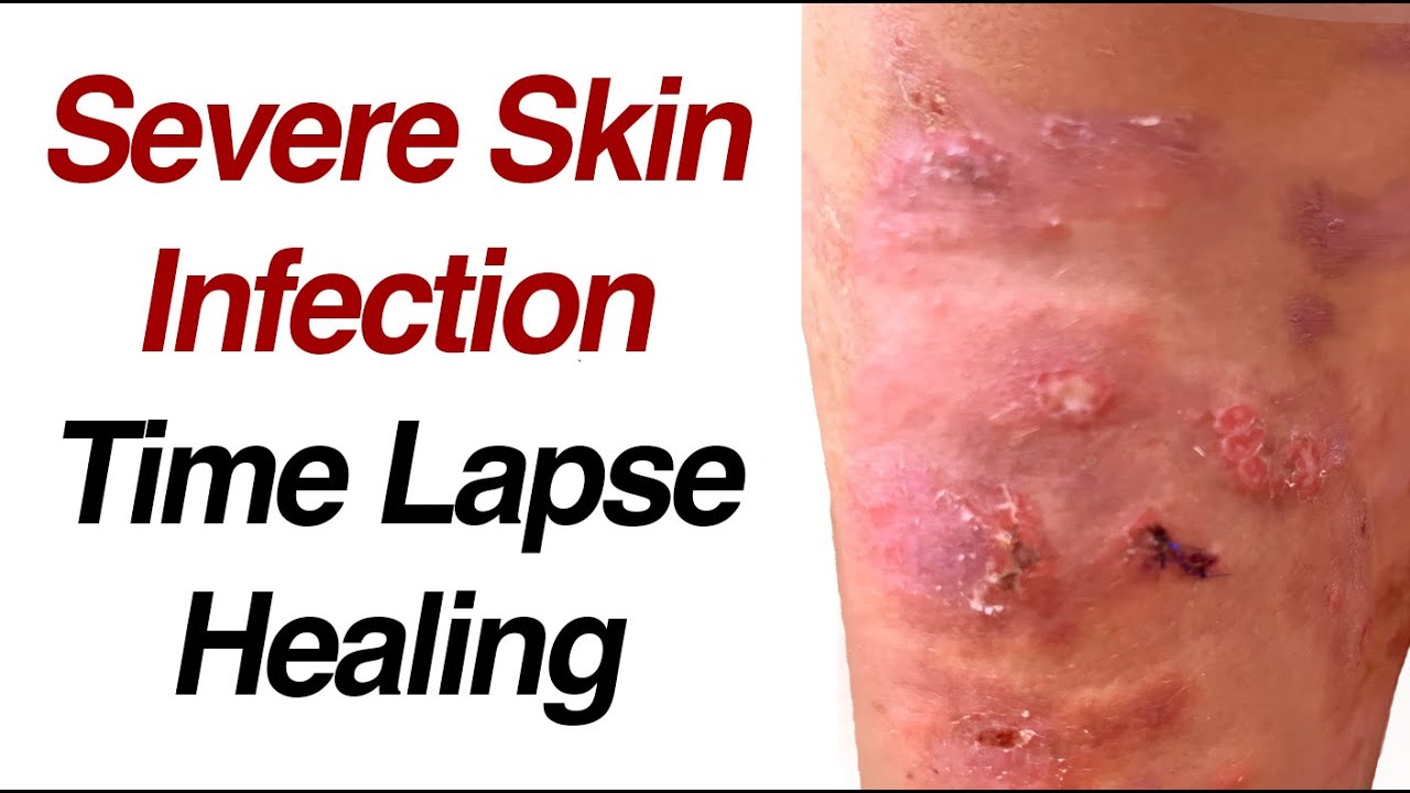 Staph Infection How To Treat