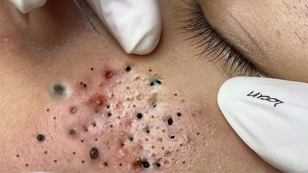Big Cystic Acne Blackheads Extraction Blackheads Milia Whiteheads