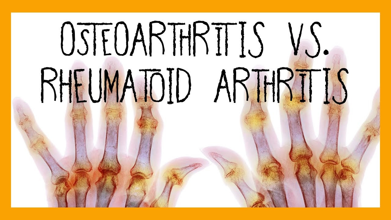 Osteoarthritis Vs Rheumatoid Arthritis Hands Inflammatory Arthritis