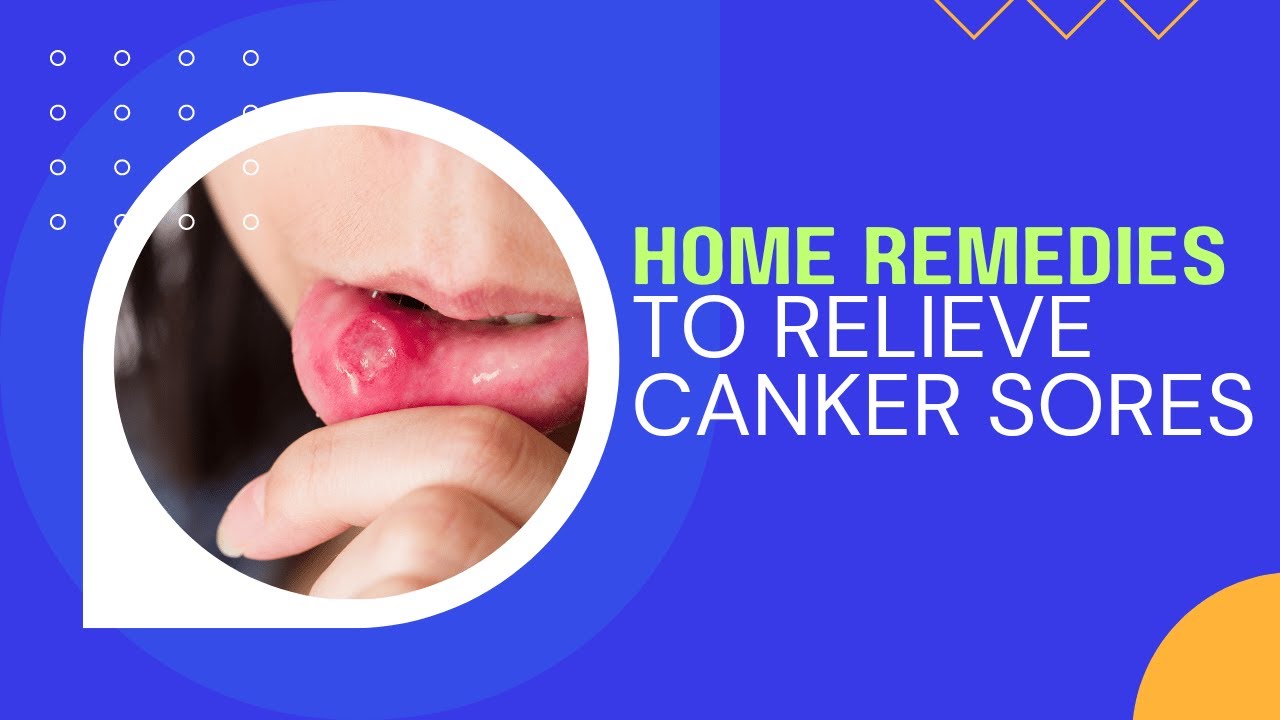 Home Remedies To Relieve Canker Sores 8 Guaranteed Tips Youtube