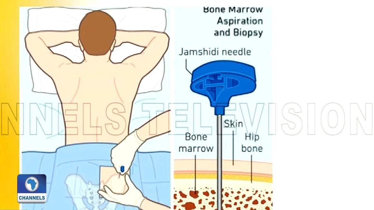 Sickle Cell Anemia Bone Marrow Transplant