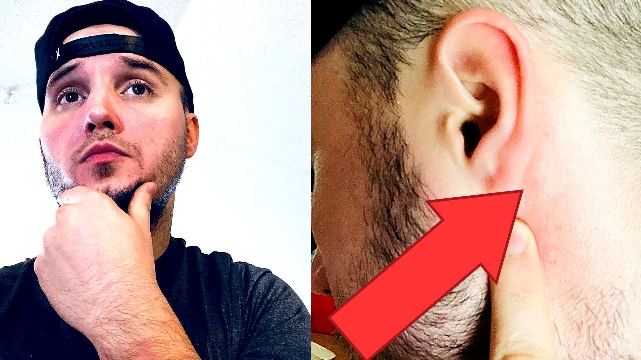 What Causes A Painful Lump Behind The Ear Infoupdate Org