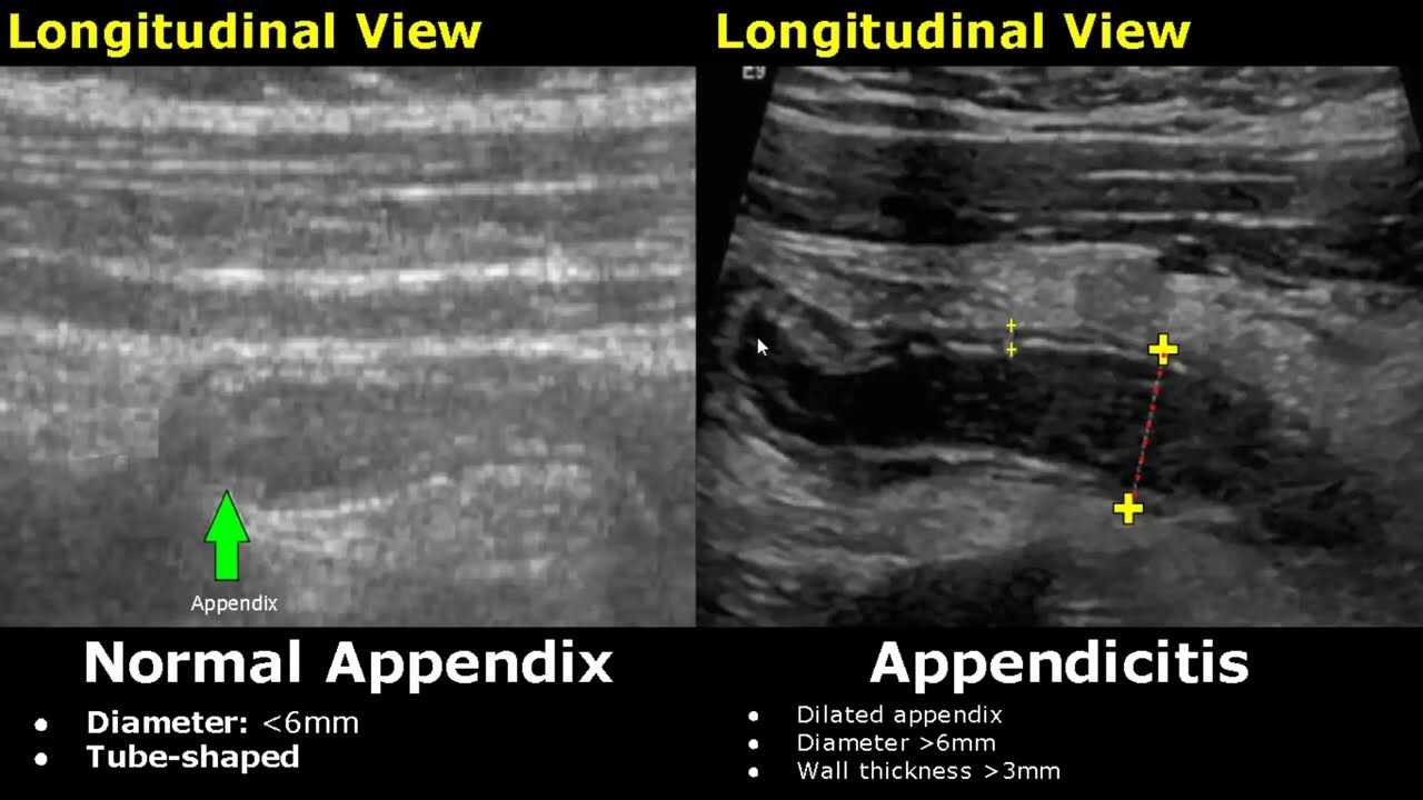 Symptoms Early Appendicitis Ultrasound