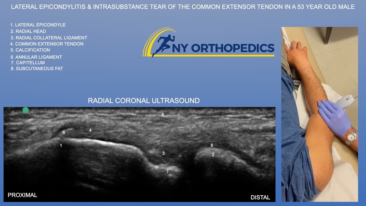 Ultrasound Of Lateral Epicondylitis With Intrasubstance Tear Of The