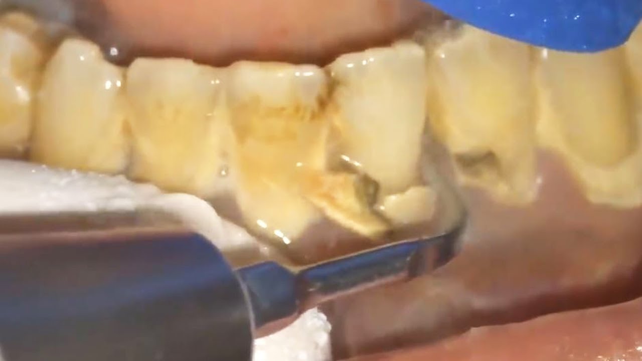 Dental Calculus Removal At Susan Cochrane Blog