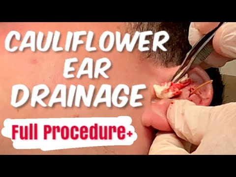 Cauliflower Ear Drainage Removing Blood From Under Skin Extreme