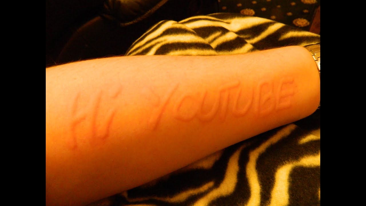 My Dermatographia Youtube