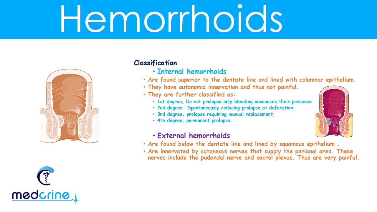 Hemorrhoids Causes Types Clinical Features Diagnosis And Treatment