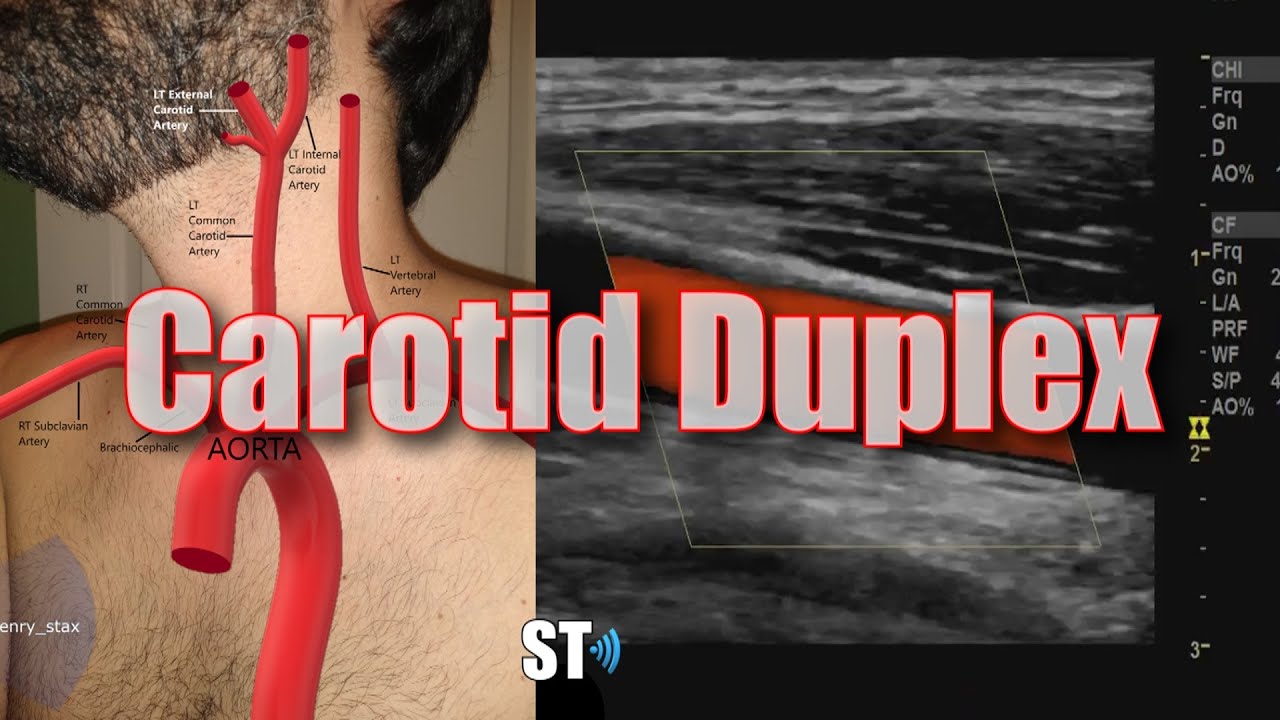 Carotid Duplex Exam Youtube
