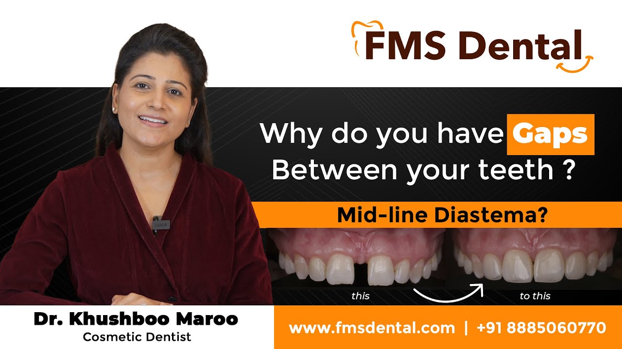 3 Simple Ways To Fix Gaps Between Your Teeth Dental Veneers Crowns