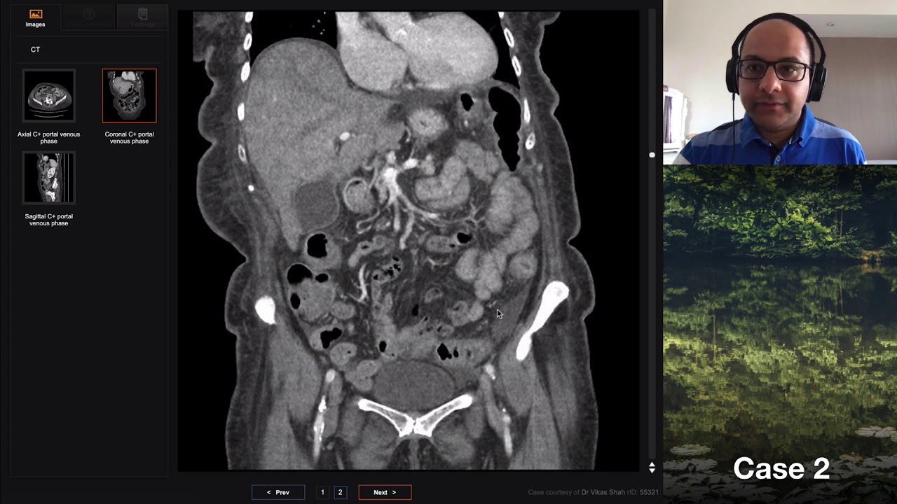 Isolation Tutorial Abdominal Ct With Vikas Shah Youtube
