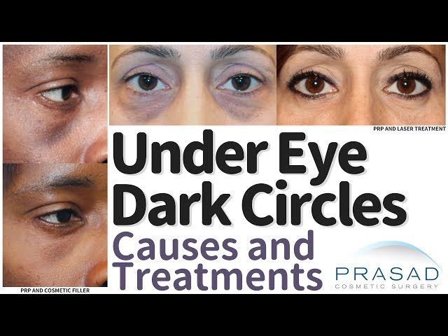 Causes Of Severe Dark Circles Under Eyes Infoupdate Org