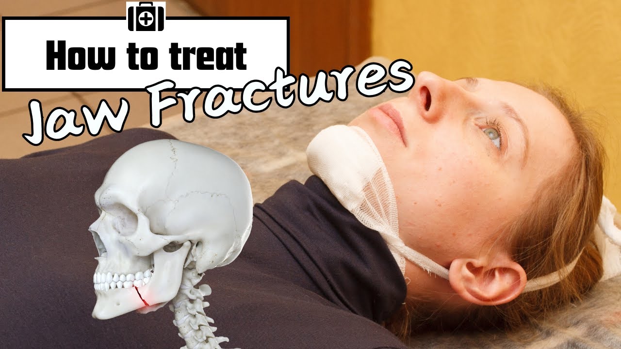 How To Treat Jaw Fractures First Aid Steps And Recovery Tips Youtube