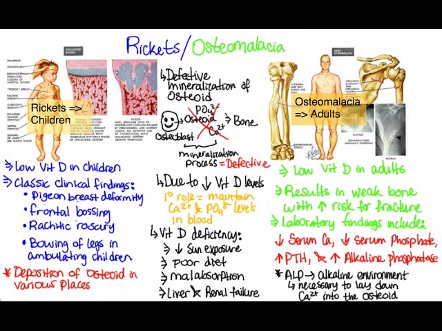 Osteomalacia Diagnosis Adult Osteomalacia Neurology