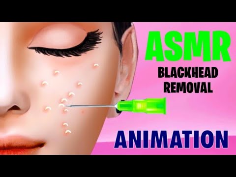 Asmr Blackhead Removal Animation Youtube