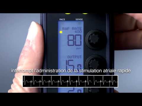 53401 Rapid Atrial Pacing Youtube