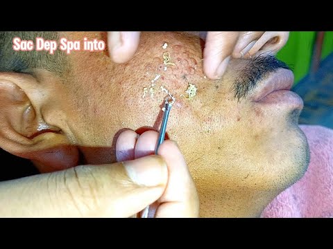 Sac Dep Spa Big Deep Blackheads Treatment Asmr Sac Dep Spa Pimple
