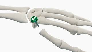 Biopro Modular Thumb Implant Joint Replacement Surgery Animation Biopro ...