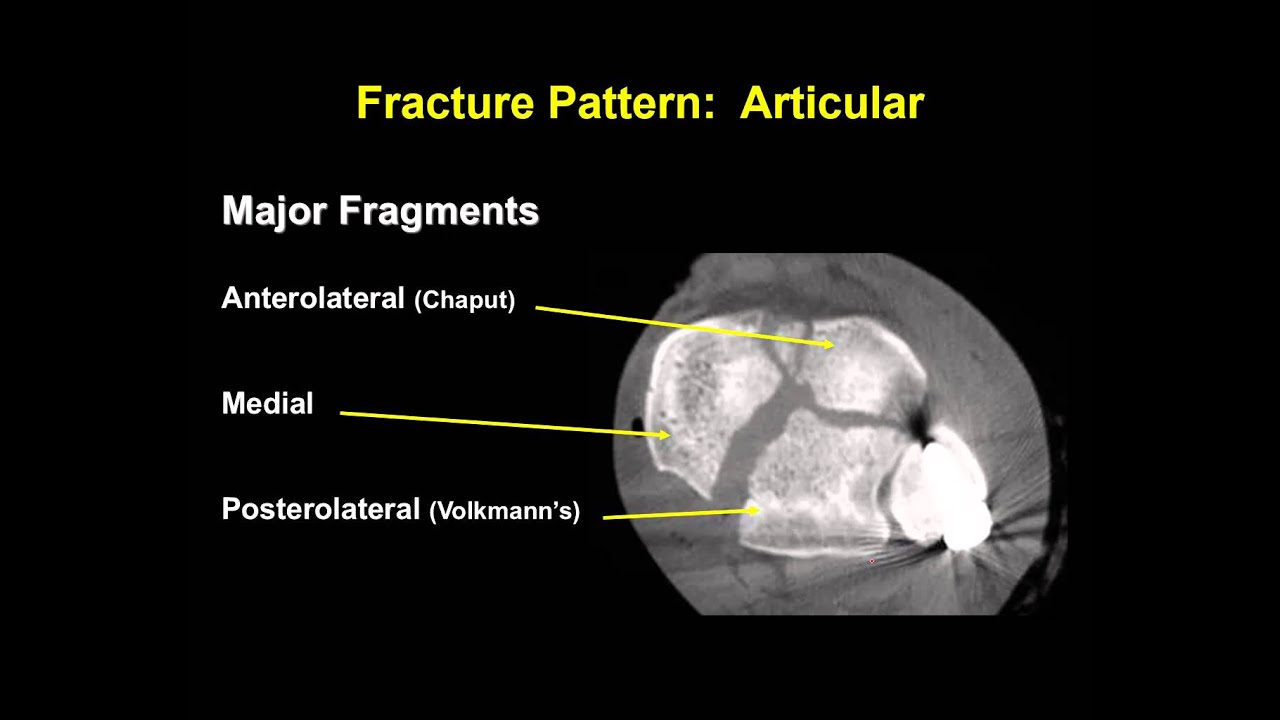 Tibial Pilon Fractures 1 Youtube