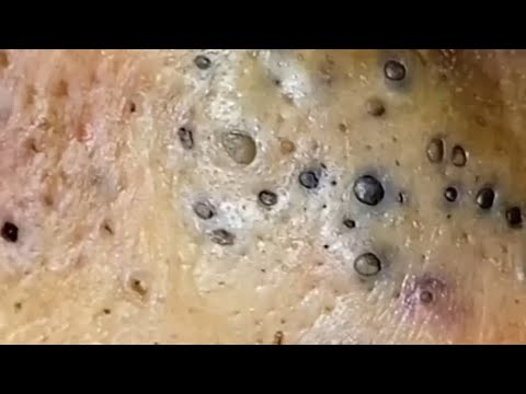 Most Satisfying Blackheads And Whitehead Removal Pimplepopping