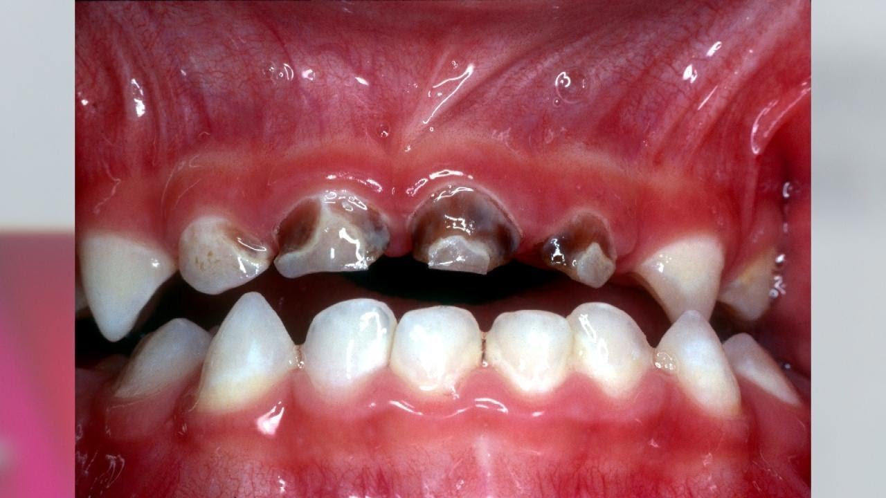 How To Prevent Baby Bottle Tooth Decay Youtube