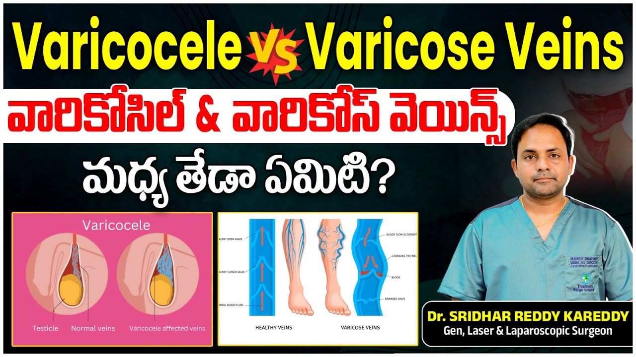 Difference Between Varicose Veins And Varicocele Varicocele Vs
