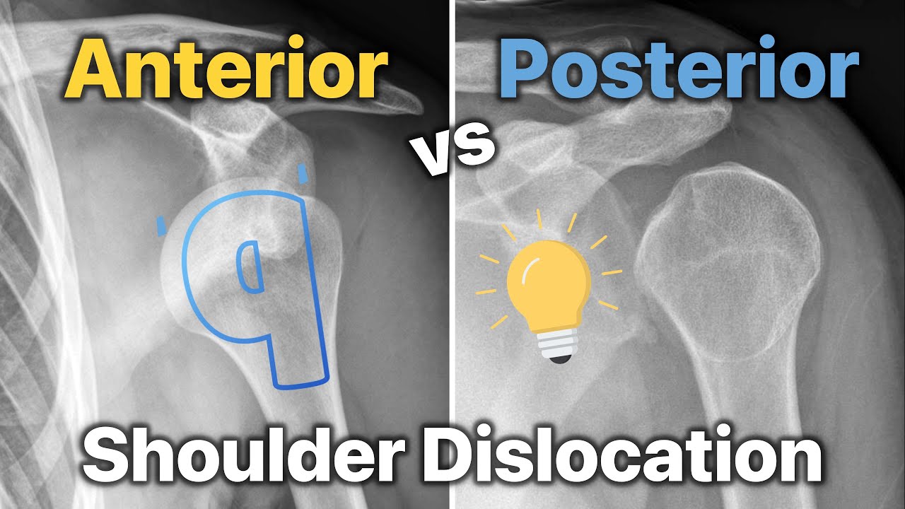 How To Diagnose Anterior Vs Posterior Shoulder Dislocations Youtube