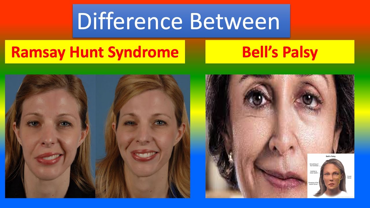Difference Between Ramsay Hunt Syndrome And Bell S Palsy Youtube
