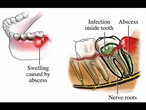 Dental Abscess Drainage Abscess Tooth Removal Youtube